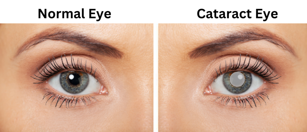 Cataract Surgery in Pune | Advanced Treatment at Mahaveer Eye Hospital